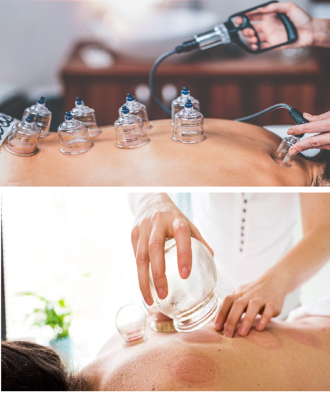 Cupping & Fire Cupping Weekend Workshop - Alternative Healing Wellness ...